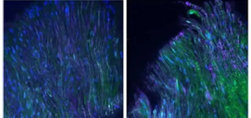 Preventing Schwann Cells from Producing GDNF May Reduce NF1 Pain ...